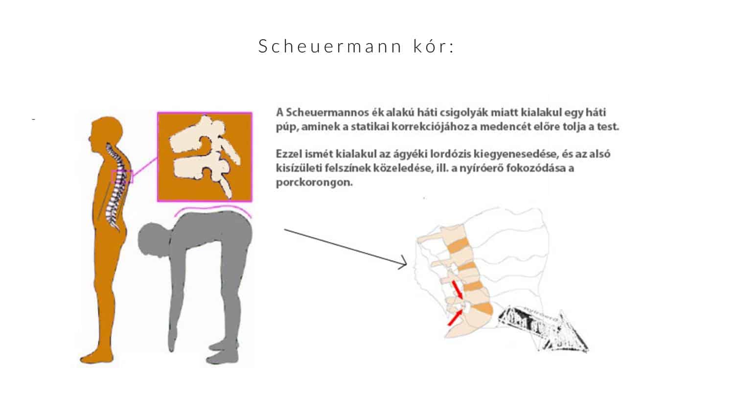 Scheuermann kór - mi lesz később, ha elhanyagolják? - Bene Gerincakadémia